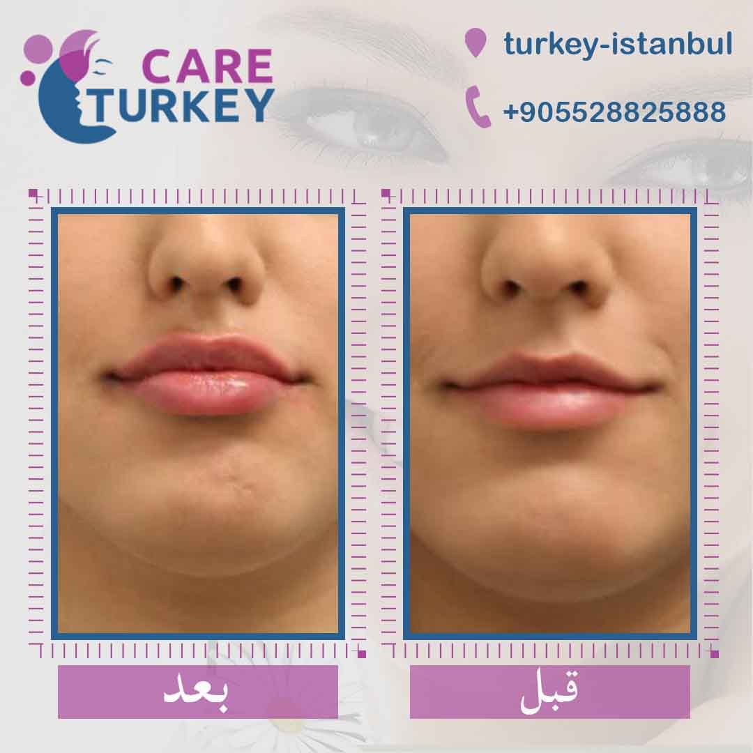 حقن الفيلر في تركيا - عمليات التجميل في اسطنبول